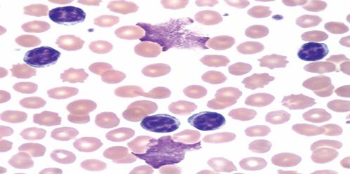 LEUCEMIA LINFOCÍTICA CRÓNICA